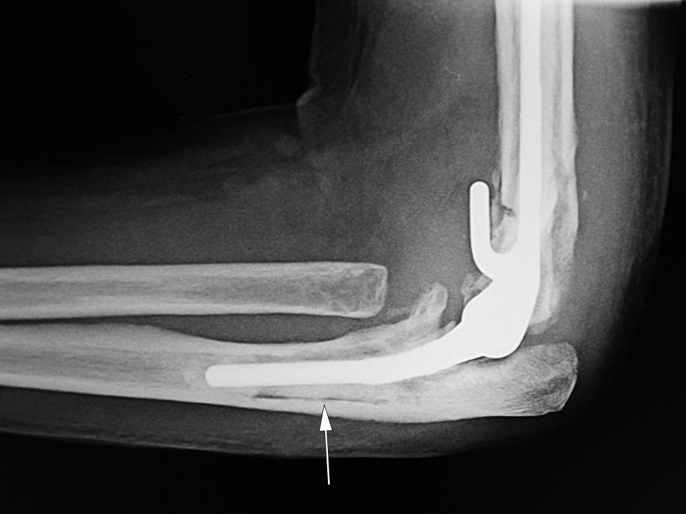 Index of /Complications/images/
