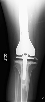Joint Arthroplasty: a gallery