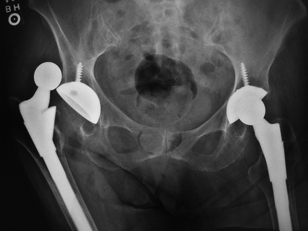 Joint Arthroplasty A Gallery Joint Arthroplasty A Gallery