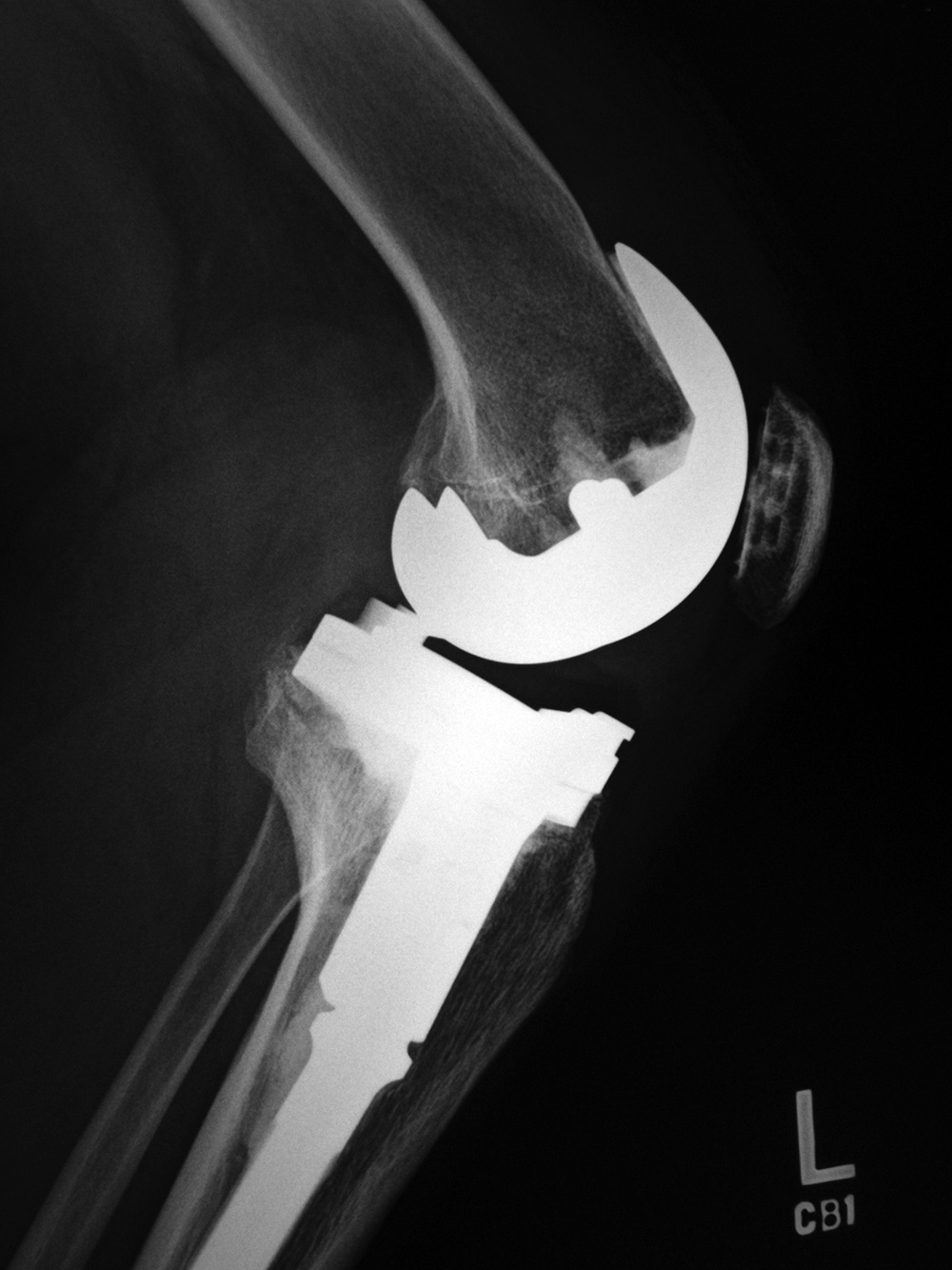 Joint Arthroplasty A Gallery Joint Arthroplasty A Gallery