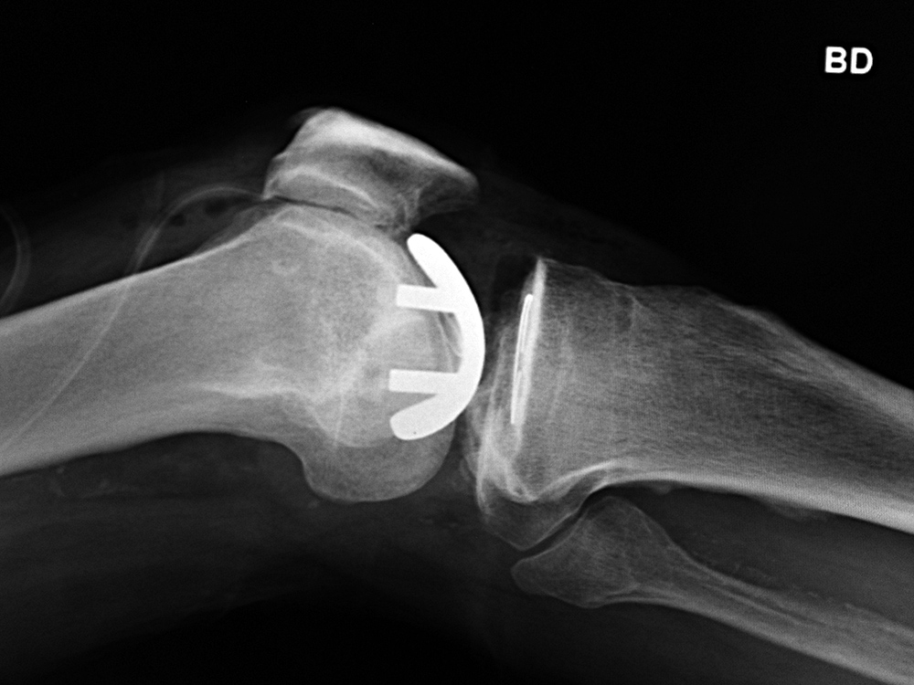 Index of /Ortho/Images/JointArthroplasty/