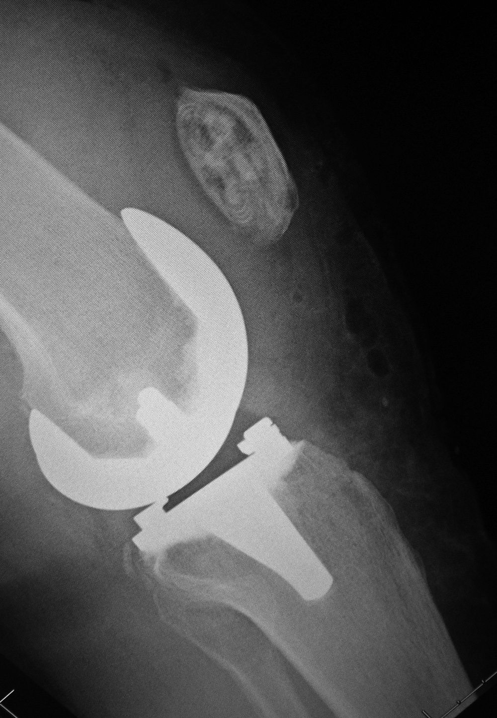 Index of /Ortho/Images/JointArthroplasty/