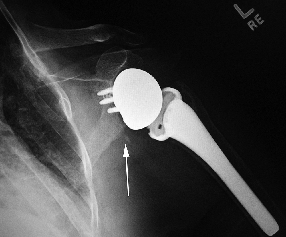 Joint Arthroplasty A Gallery Joint Arthroplasty A Gallery